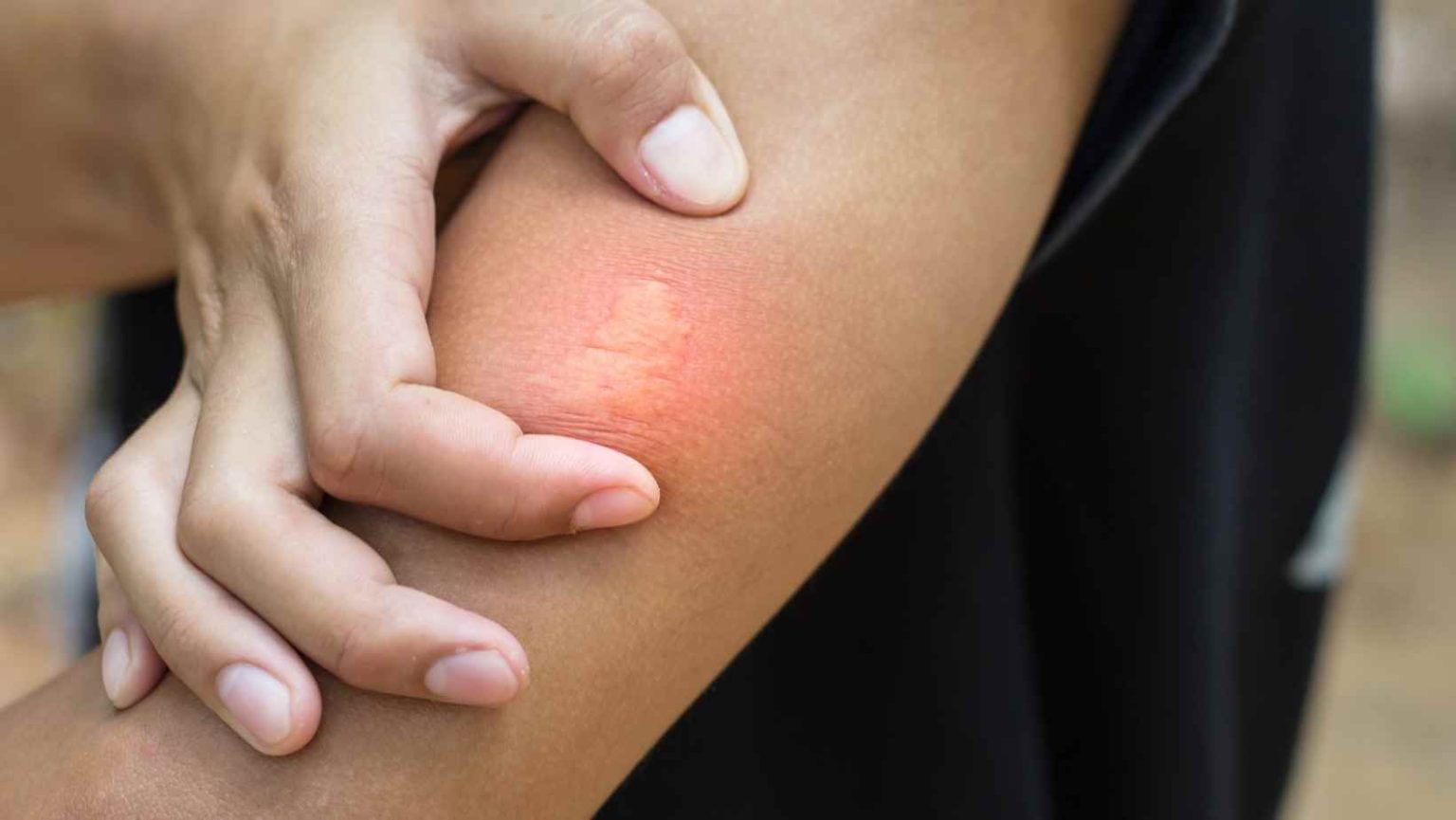 First Aid For Bites And Stings In Australia | The First Aid Nest