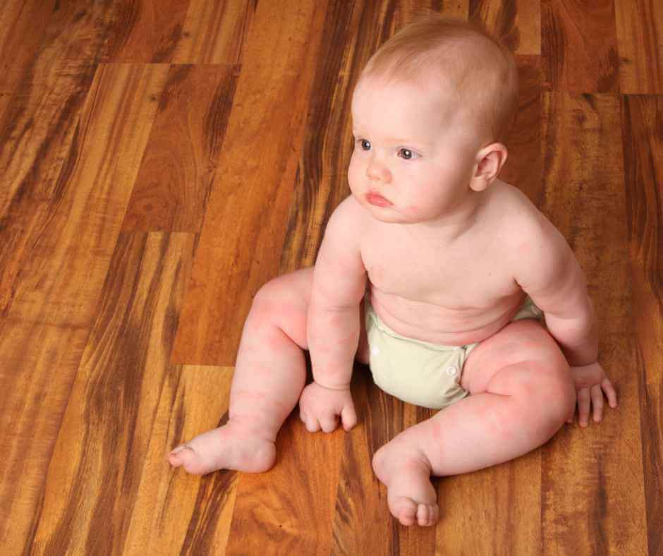 Allergic Reaction In a Baby | The First Aid Nest