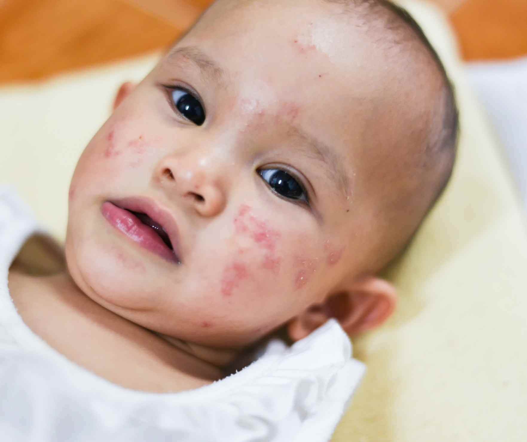 My Baby Has A Rash, What Should I Do? | The First Aid Nest