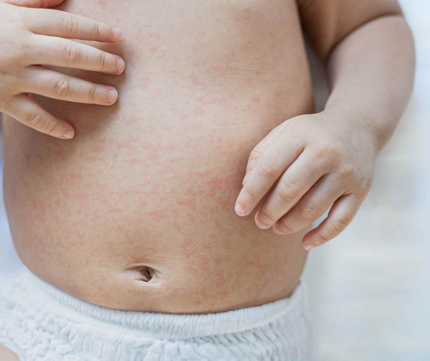 My Baby Has A Rash, What Should I Do? | The First Aid Nest