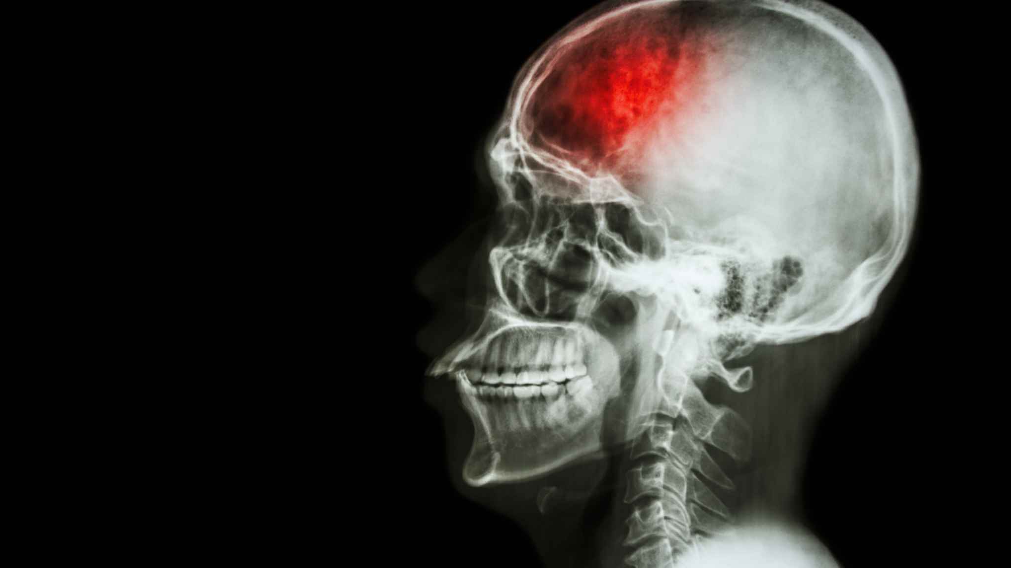 First Aid For A Stroke | The First Aid Nest