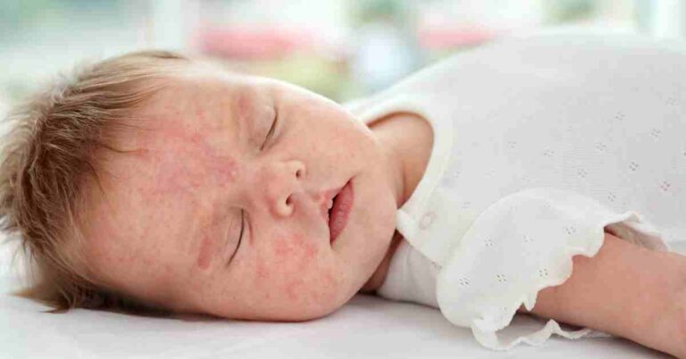 How to Respond to Anaphylaxis in a Baby: Quick Action Guide - The First ...