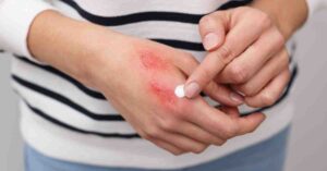 First Aid for Burns: How to Treat Different Types of Burns at Home ...