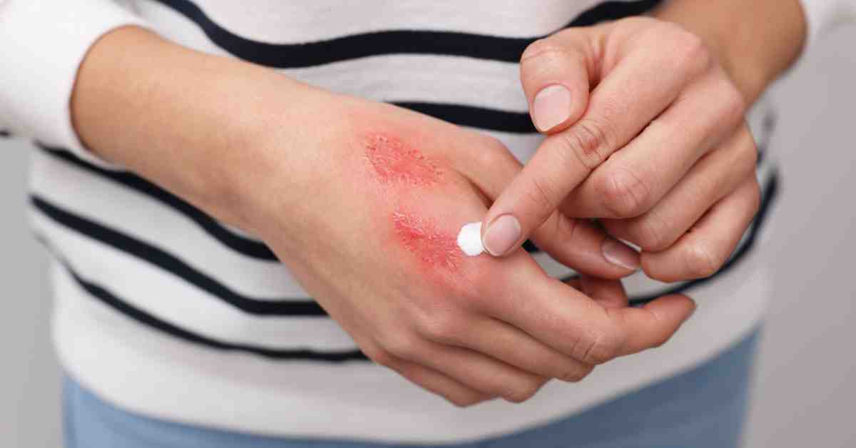 First Aid for Burns: How to Treat Different Types of Burns at Home ...